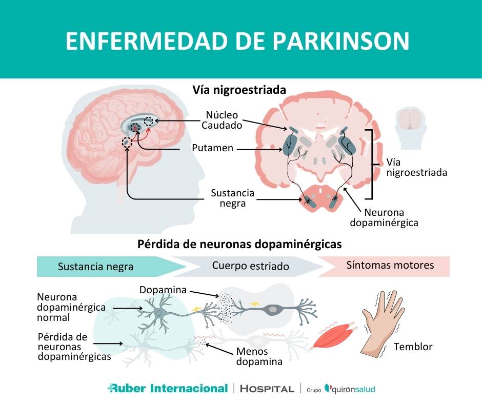 Diagnóstico precoz de Parkinson: Avances en Resonancia Magnética de Alto Campo